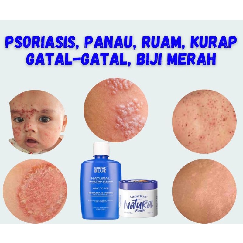 PSORIASIS ECZEMA PANAU KAYAP GATAL RUAM MERAH BIJI SKIN PROBLEMS MAGIC ...