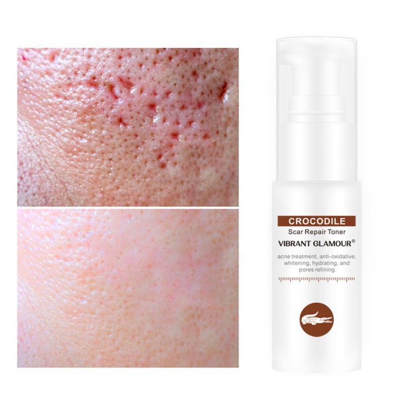 VIBRANT GLAMOUR Crocodile Scar Repair Face Serum 30ml Acne Scar Removal ...