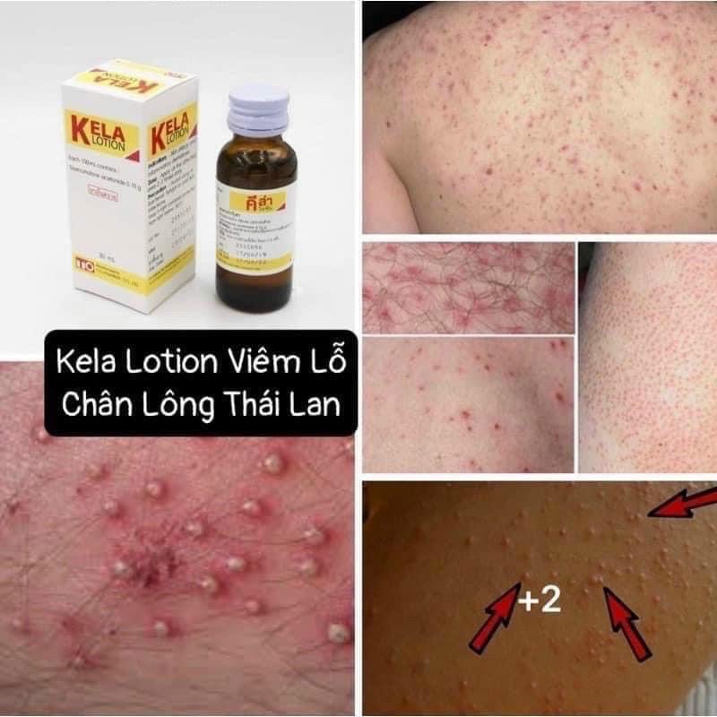 [Sales Only Thailand] KELA LOTION Treats Thai Hairs 60ML | Shopee Malaysia