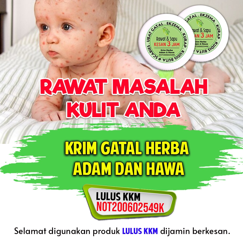 Ubat gatal JOLICARE BABY Eczema Cream Krim Gatal Kulit Ubat Panau Ubat ...