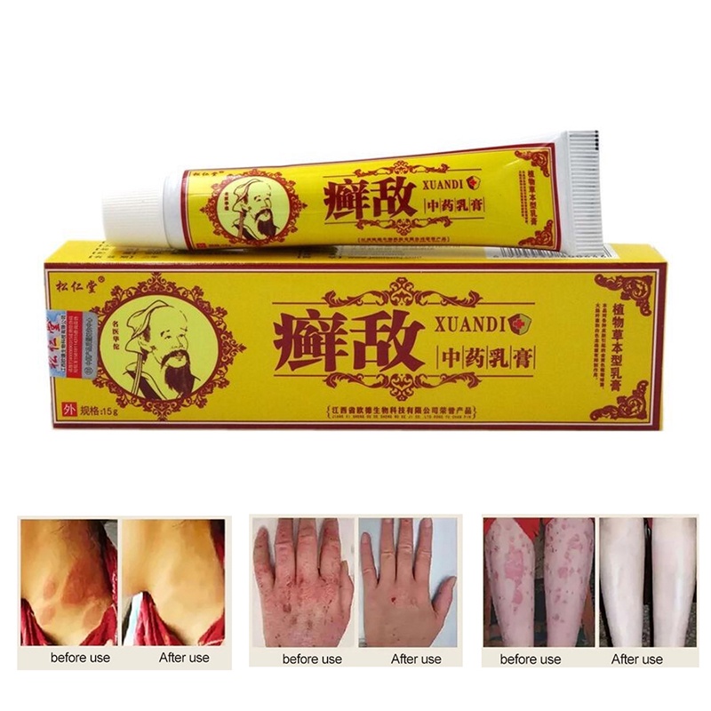 Psoriasis Eczema Cream Antifungal Antibacterial Itchy Cream Eczema