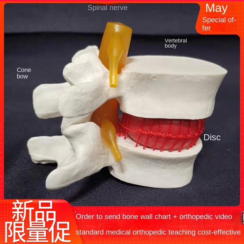 Human Spine Lumbar Intervertebral Disc Protrusion Model Magnification ...