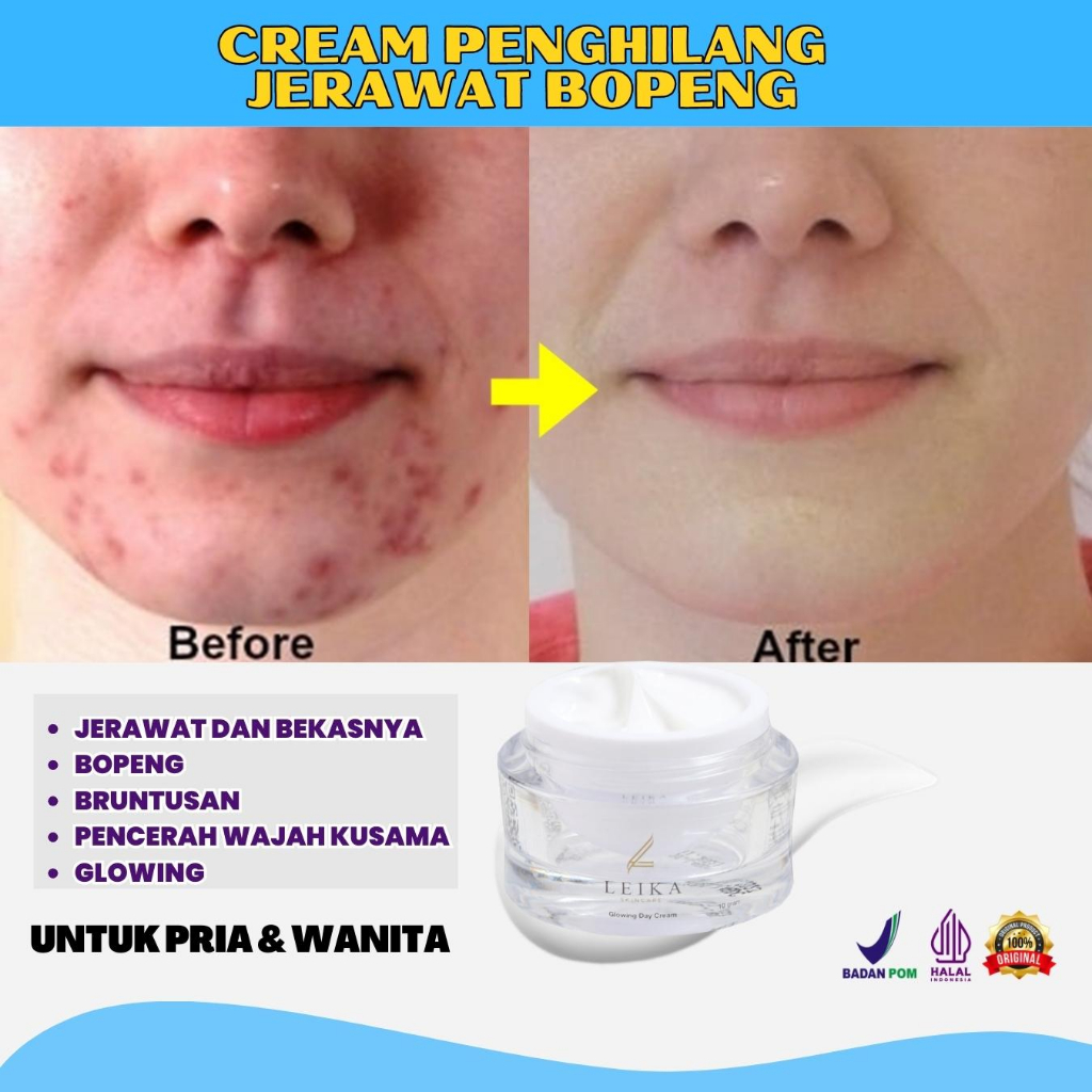 HITAM Permanent acne Scars cream Powerful Bpom acne Scar Removal acne ...