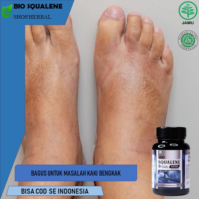 MATA Medicine for swollen feet MEDICATION for Swollen Feet, FIGHTING ...