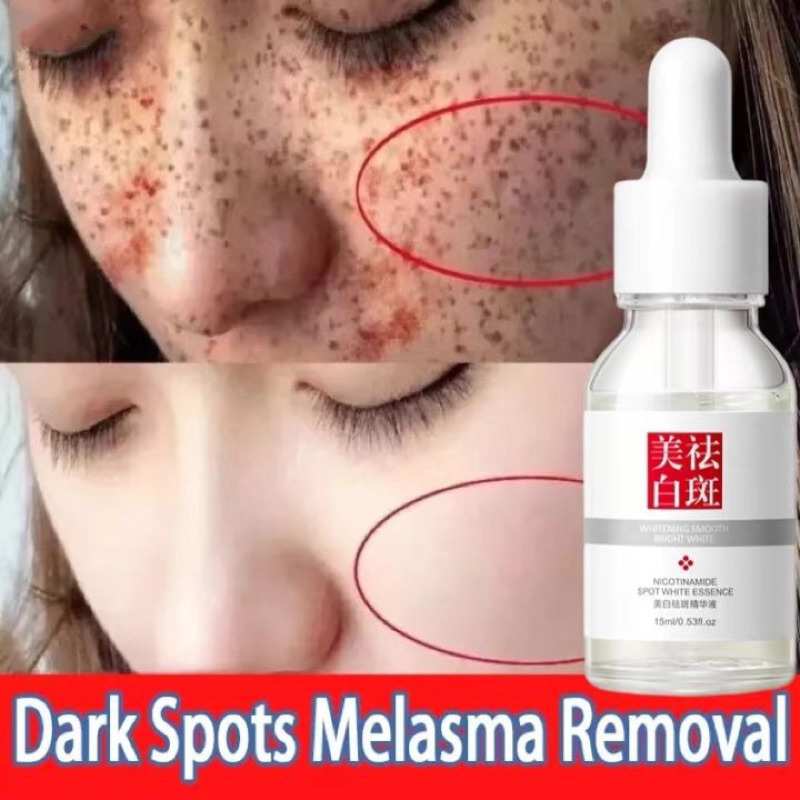 Nicotinamide Whitening Serum Freckles Remove dark Spots Melasma Brighten Lighten Melanin Improve ...