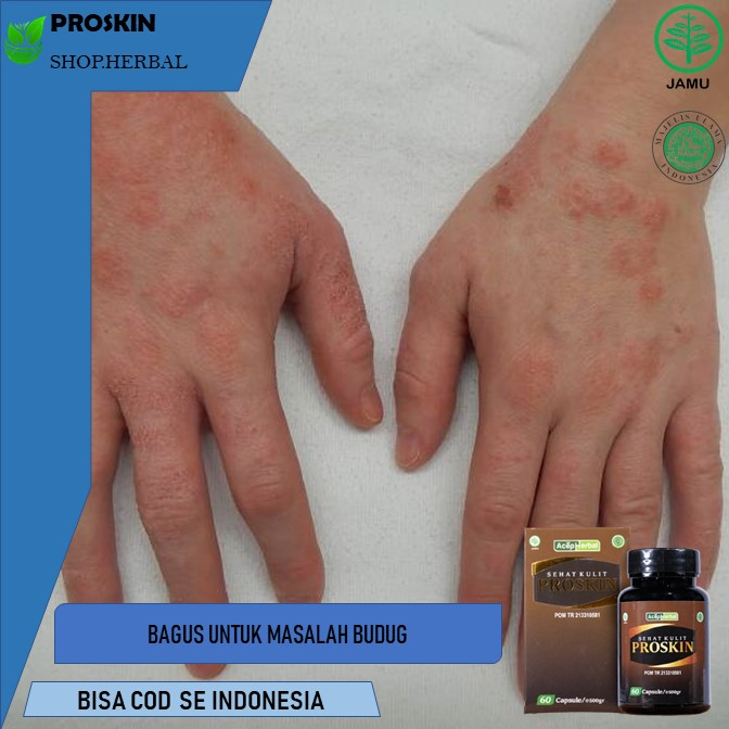MERAH Budug medicine Budug Festering medicine PROSKIN Medicine Budug ...