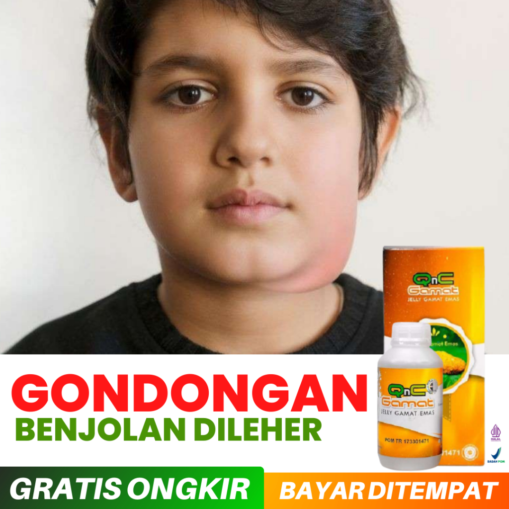 Medicine for Mumps in Adult Children Gland Lumps Swelling Neck Swelling ...