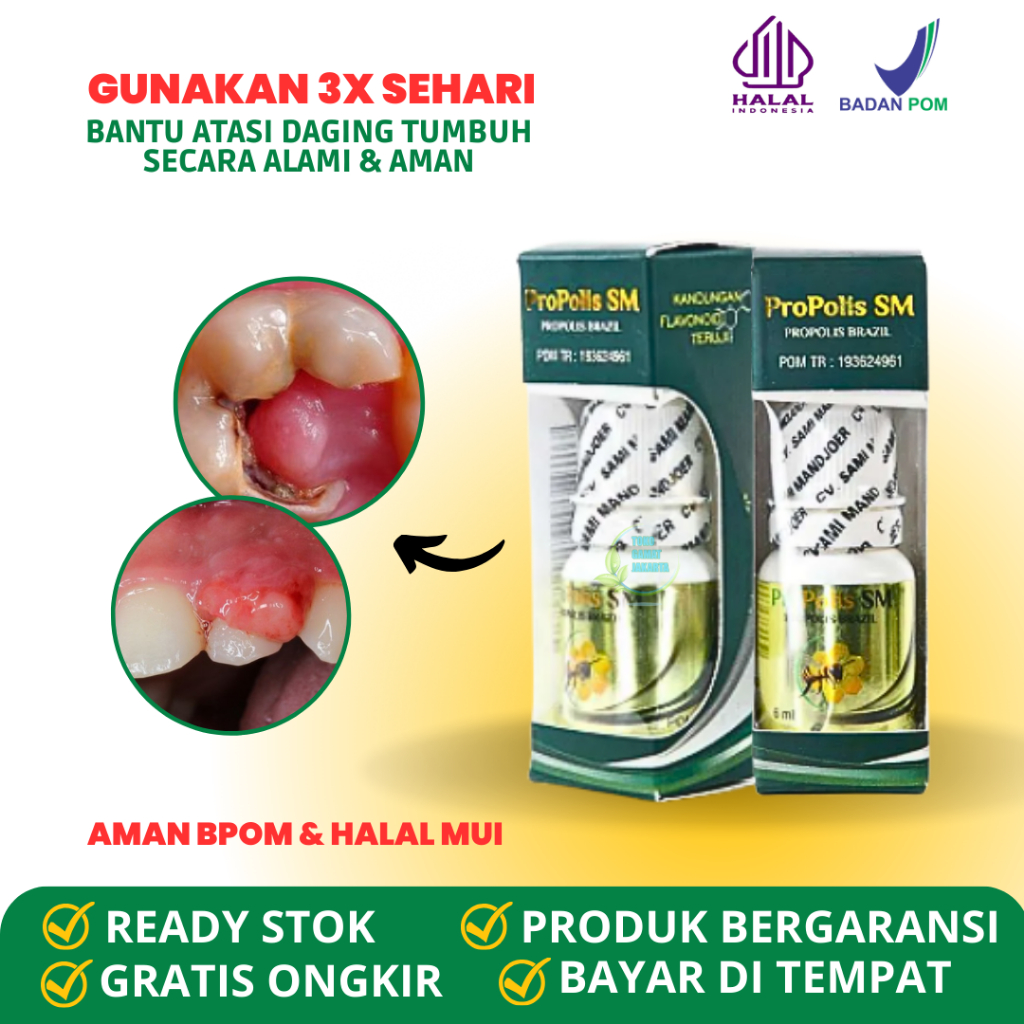 Medicine For Meat Growing In Perforated Teeth, Removal Of Dental Polyp ...