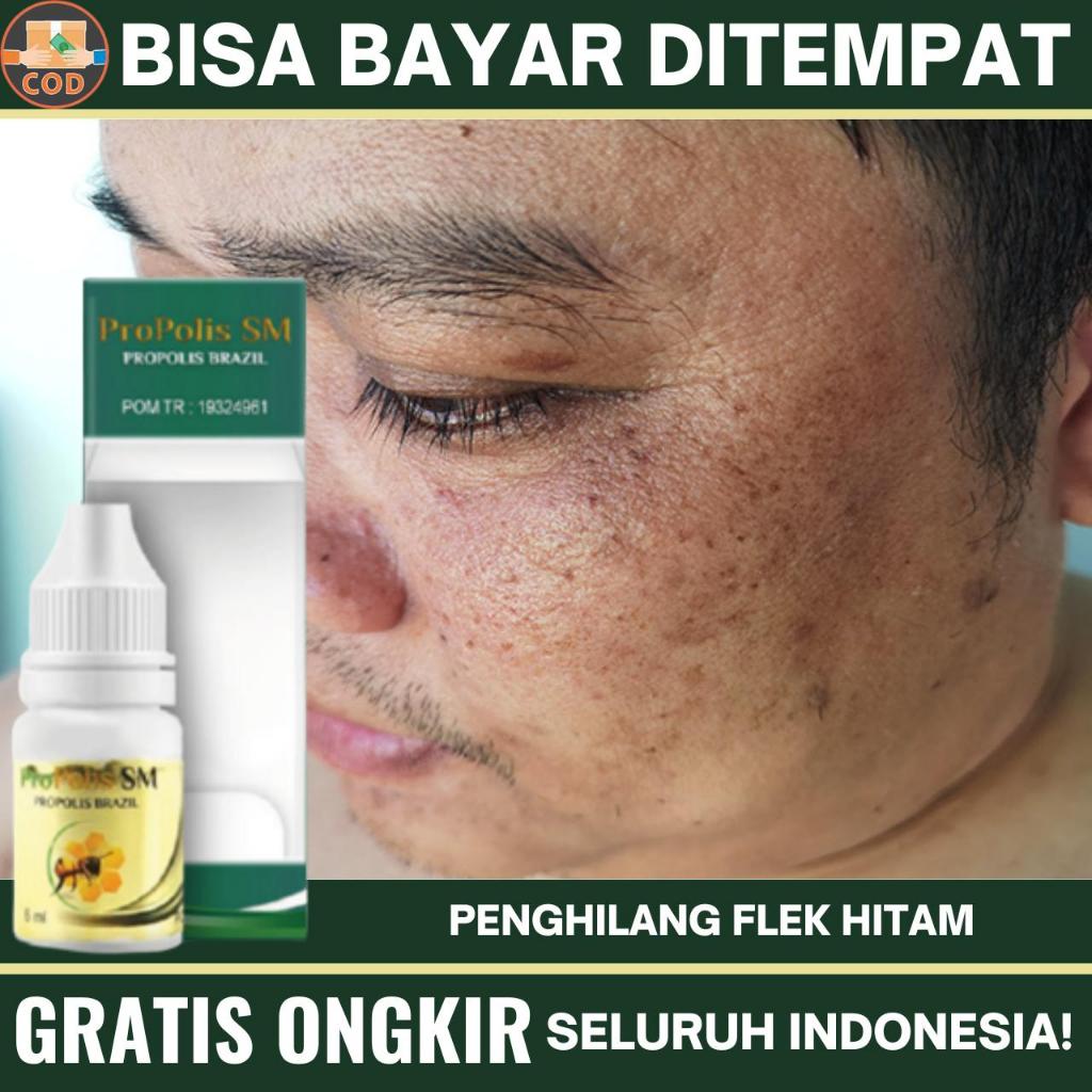 HITAM Sm Propolis, Drug To Remove Black Spots, Drug To Remove Stubborn ...