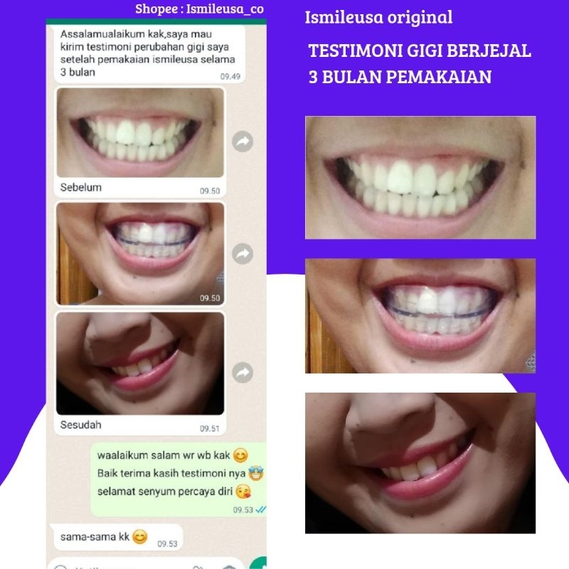 Ismileusa/dental Straightener /Teeth Trainer /Alignment/Aligner/Dental ...