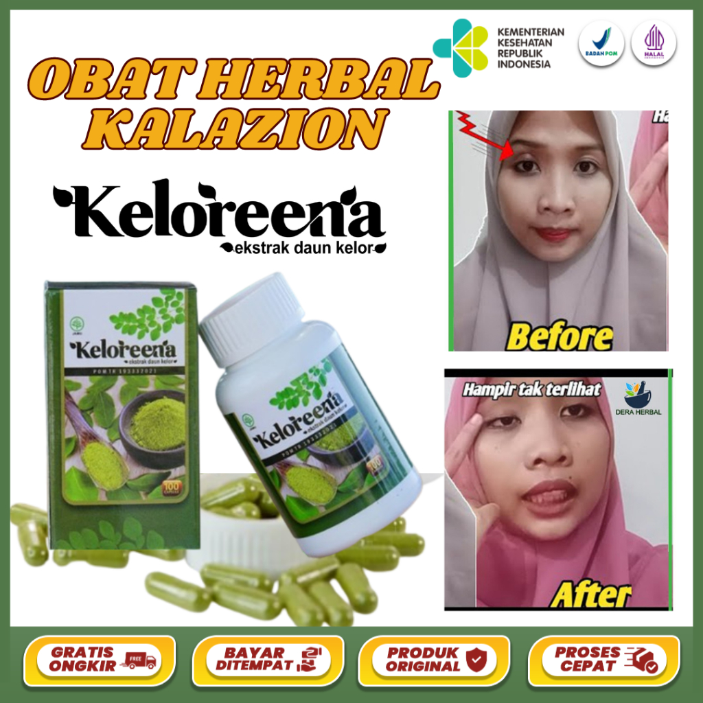 MATA Kalazion Eye Medicine Lumps On The Eyelids Lumps In The Eye Bag ...