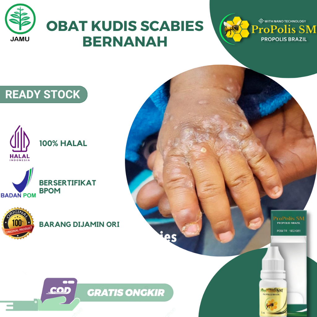 Drug For Human Scabies Scabies Medicine For Children's Scabies Itchy To ...