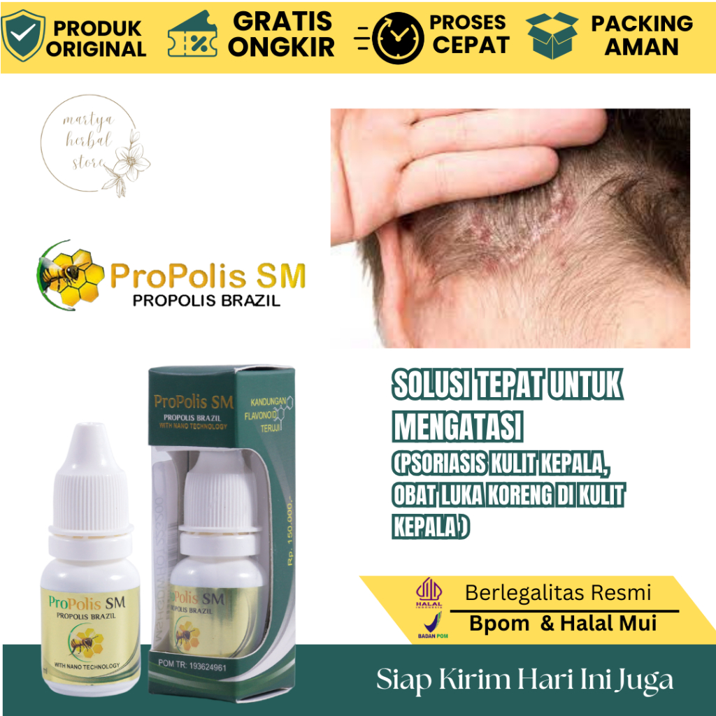 Scalp Psoriasis Medicine, Scalp Scars Medicine, Detmatitis Ulcer ...