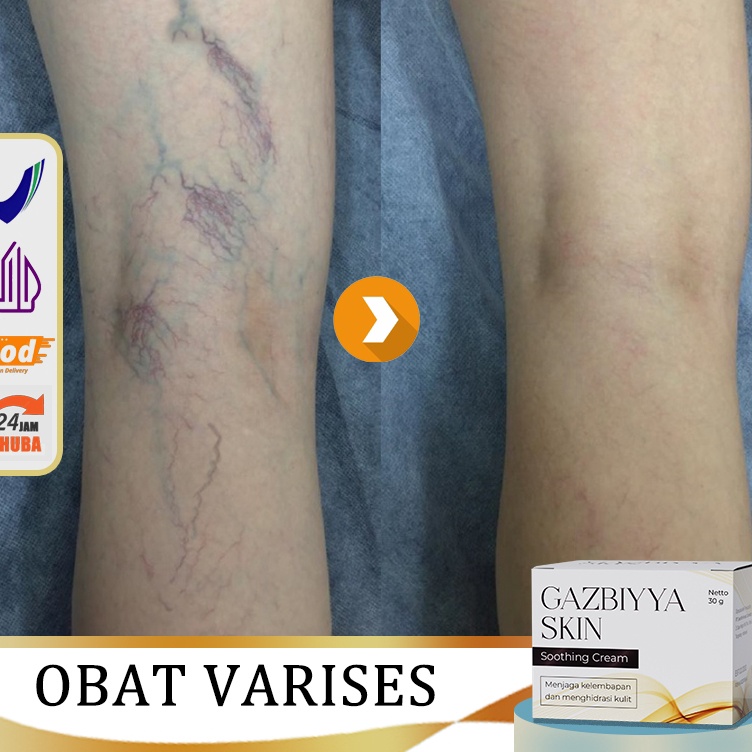 Art S44Z BPOMSalep Varicose Veins Foot Varicose Veins Medicine valesin ...