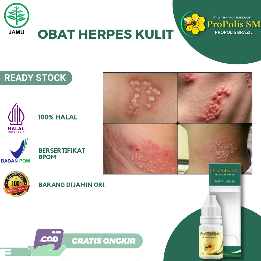 MERAH Herpes Medicine For Adult Children Herpes Simplex Herpes Zoster ...