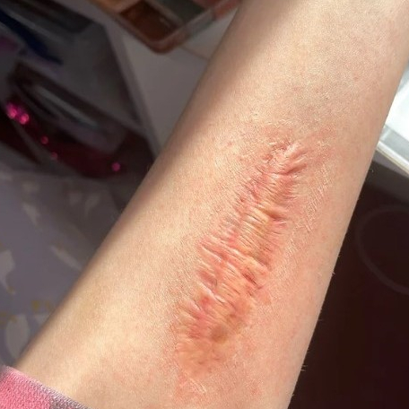 Realistic KELOID SCAR | Fake SCARS | Sfx SILICONE PROSTHETIC | Sfx ...