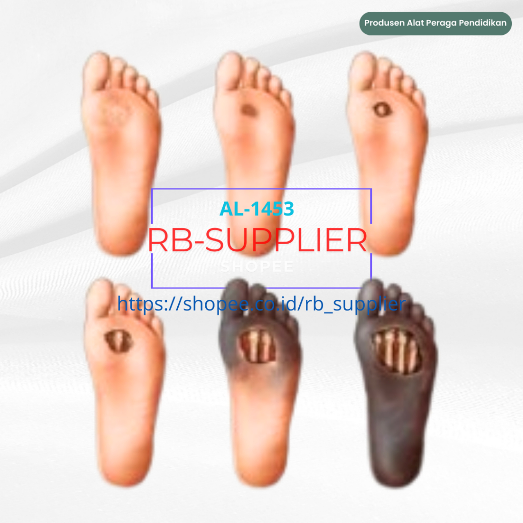 Decubitus Ulcers-Makin/Mannequin Foot Wound Model Mannequin Decubitus ...