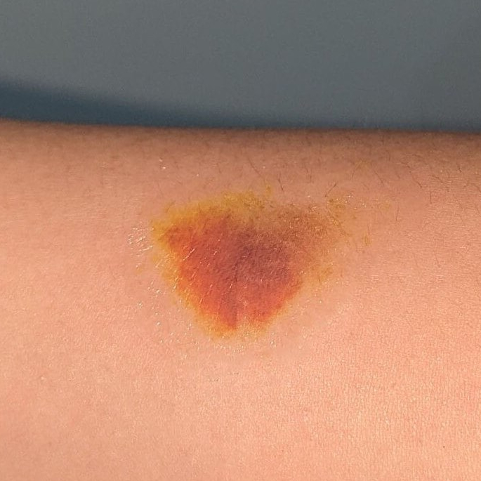 LOKAL [LOCAL PRODUCT] TEMPORARY HEALING BRUISE TATO | LEBAM TEMPORARY ...