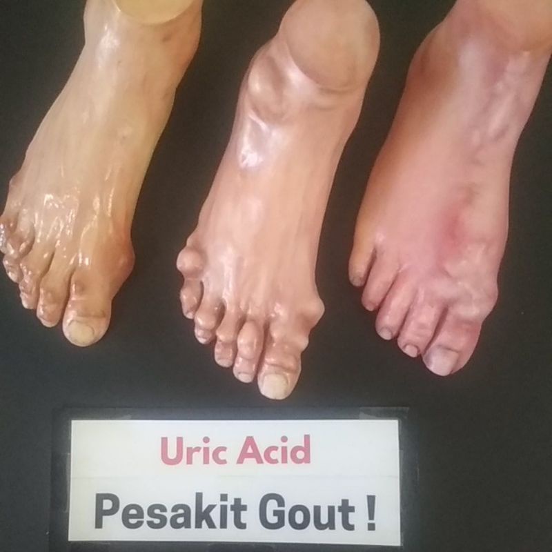 Model kaki Paparan Simptom Asid Urik/Uric Acid foot modeling display ...