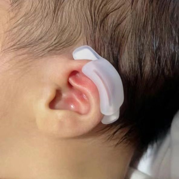 Built-in baby ears orthoses pediatric correct post correct shape correction of a Built-in baby ...
