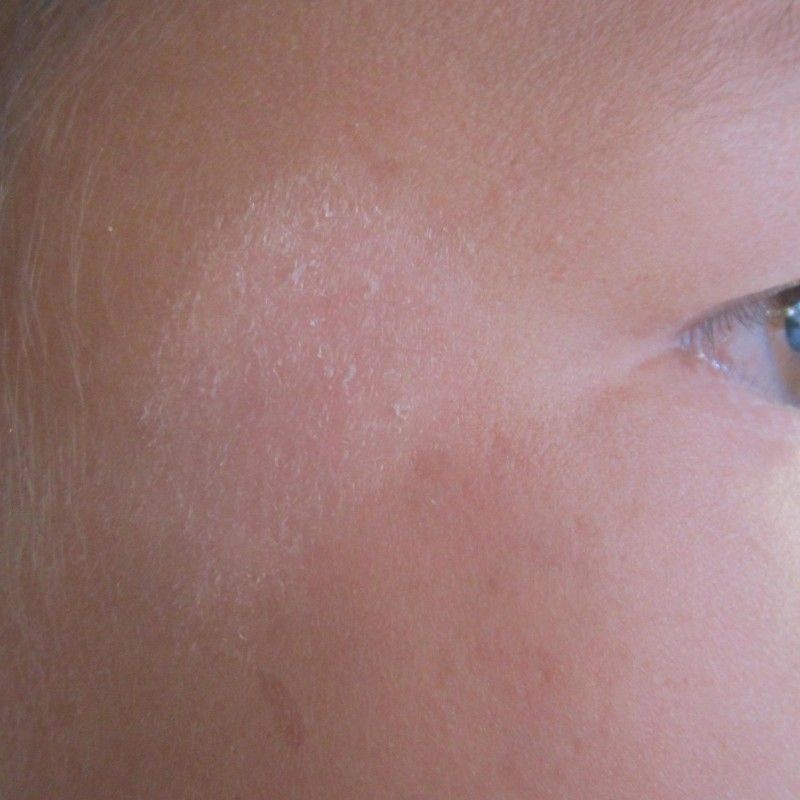 straw-straw-with-pityriasis-alba-white-spots-on-the-child-s-fa