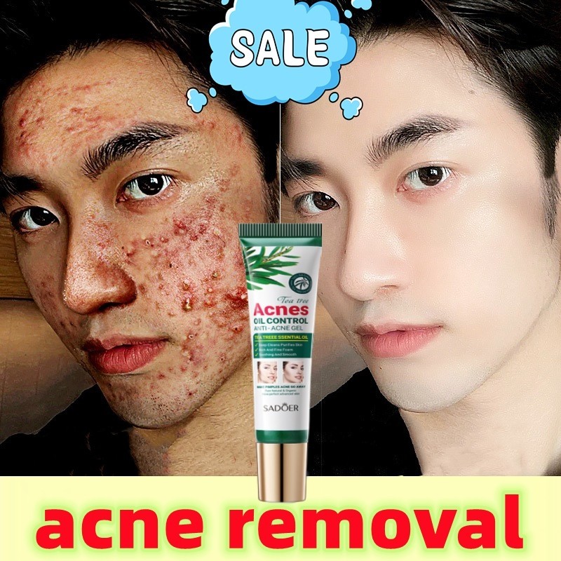 Acne cream Acne Treatment ubat jerawat dan parut Krim Jerawat Muka ...