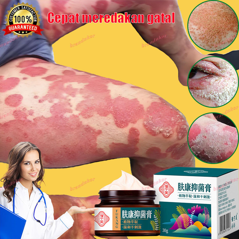 Eczema cream Itchy skin cream Krim gatal kulit Krim gatal kulit herba cina Psoriasis cream 30G ...