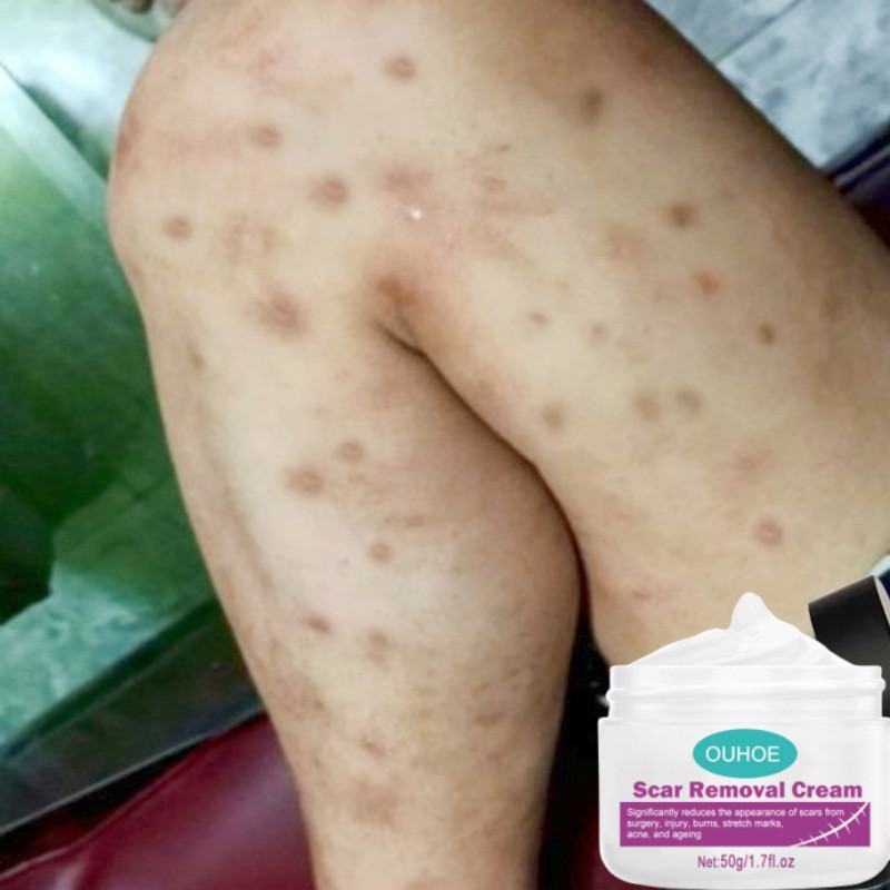 Krim hilangkan parut hitam Hilangkan parut kaki Penghilang bekas luka ...