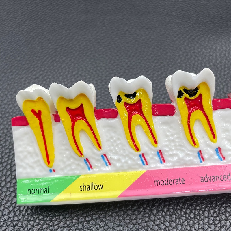 Dental Caries Classify Tooth Model of Pathological Process Around Teeth ...