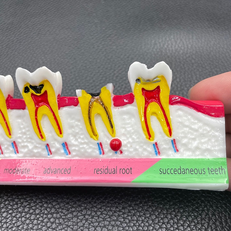 Dental Caries Classify Tooth Model of Pathological Process Around Teeth ...