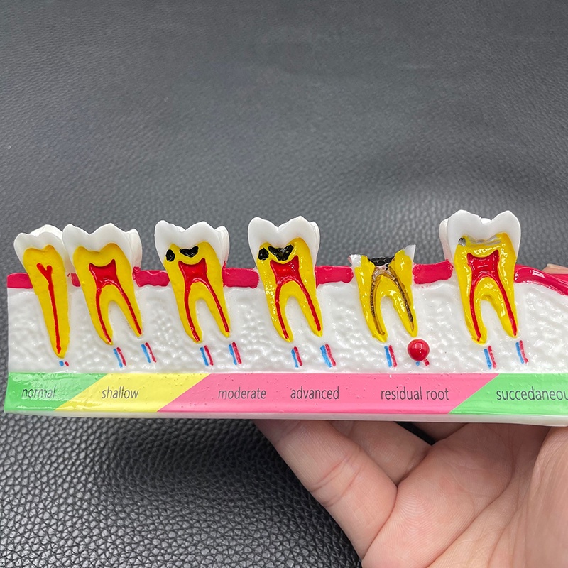 Dental Caries Classify Tooth Model of Pathological Process Around Teeth ...