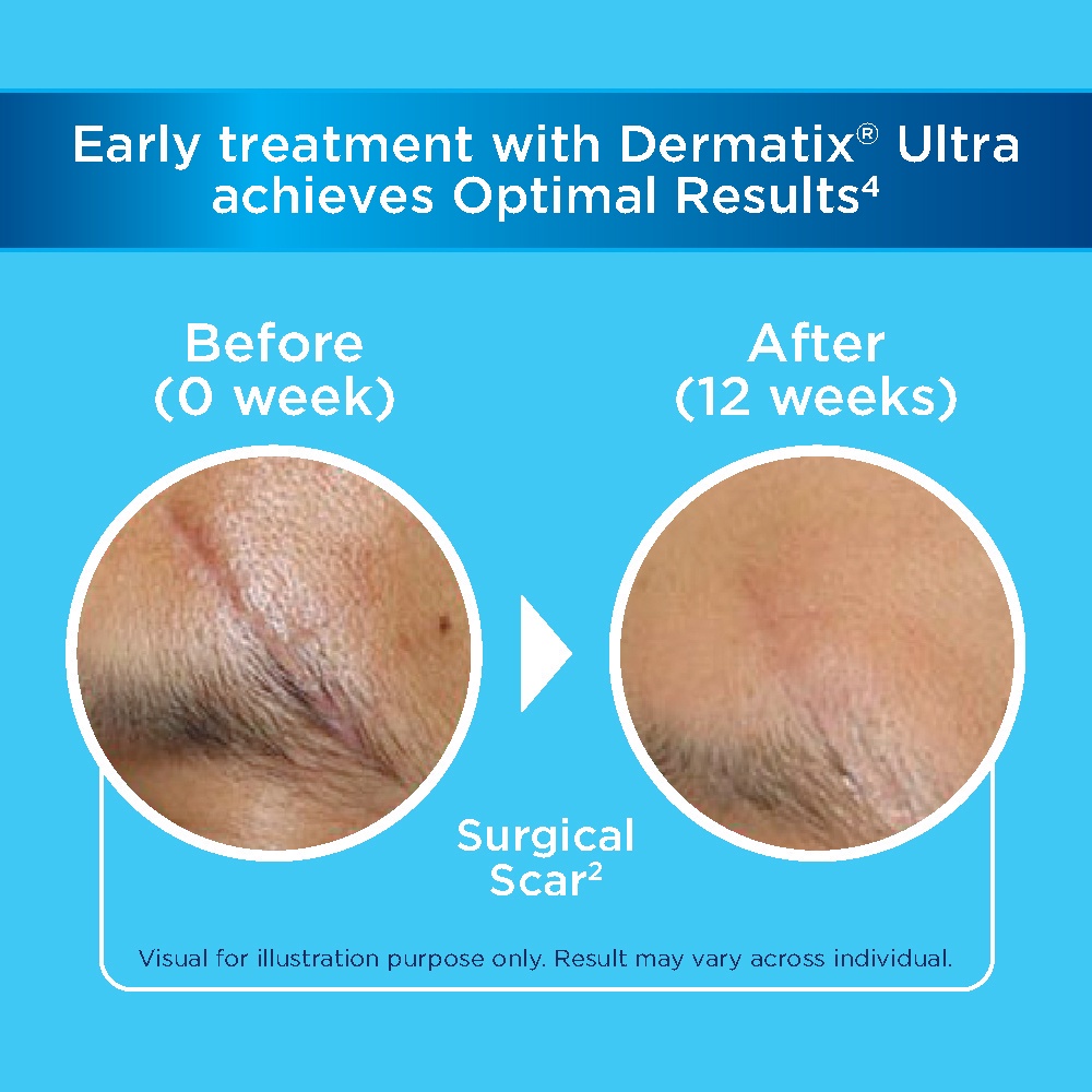 Dermatix Ultra Scar Gel 15g | Reduce Deep Scars & Post-surgery Scars ...