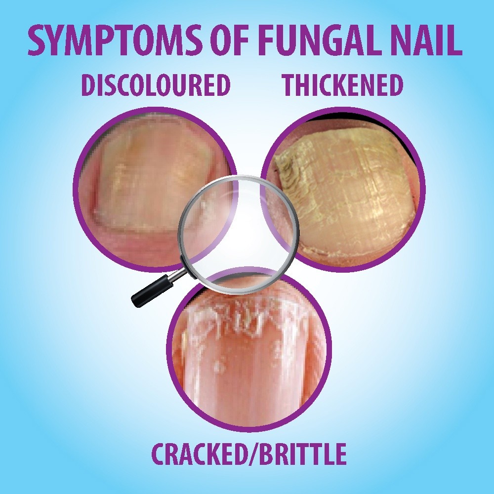 Emtrix Fungal Nail Treatment (10ml) | Shopee Malaysia