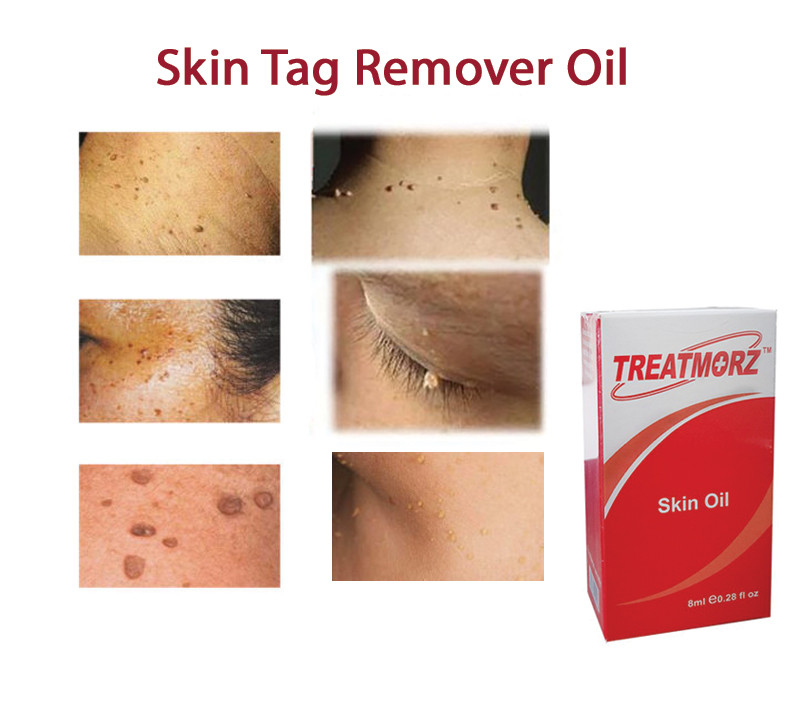 Treatmorz Skin Oil (removes skin tags gently and effectively) 8ml ...