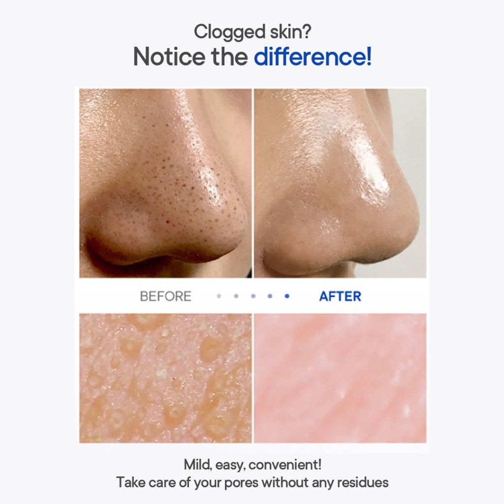 Blackhead &Sebum Removal/ Pore Cleansing/ No Pain | ONE DAY'S YOU P.Z ...