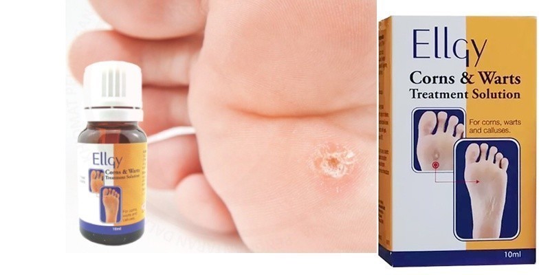 Ellgy Corns & Warts Treatment Solution 10ml | Shopee Malaysia
