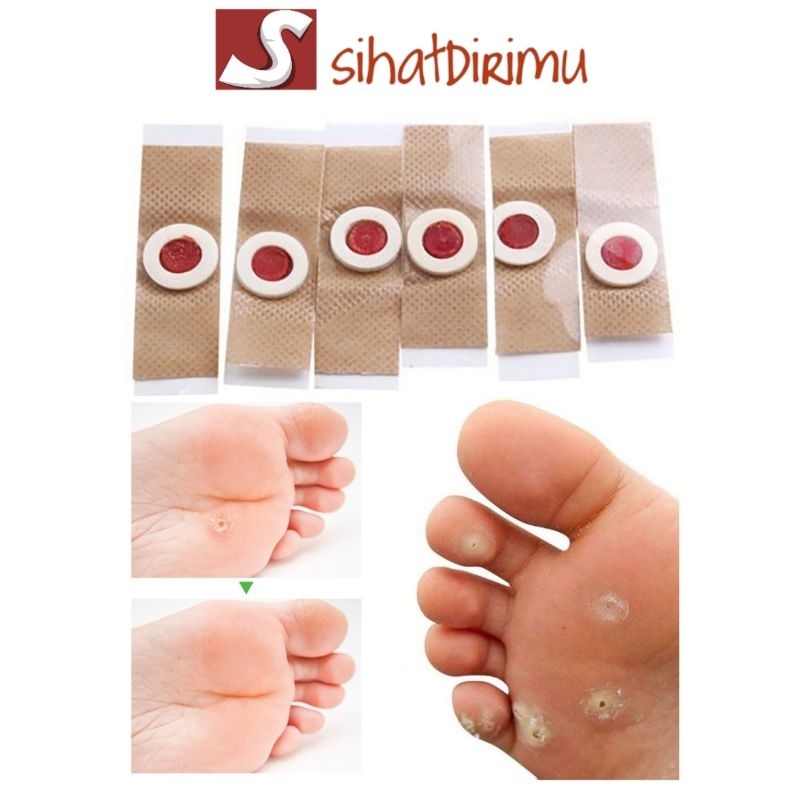 Plaster Ketuat Kaki Jari Corn Wart Plaster 6pcs | Shopee Malaysia