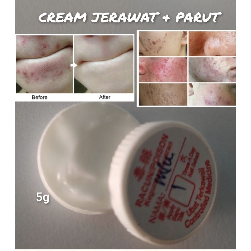 KRIM HILANGKAN JERAWAT,JERAGAT&PARUT (5g) | Shopee Malaysia