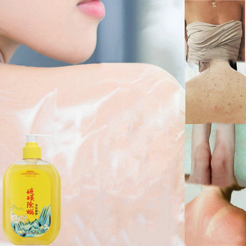 jerawat badan acne body wash sulfur mite removal shower gel antibacterial eczema kulit gatal ...