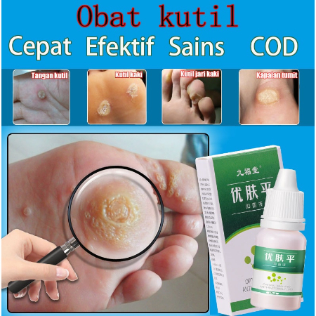 Skin Tag Mole Wart Removal Obat kutil Obat mata ikan Ubat Buang Tahi ...