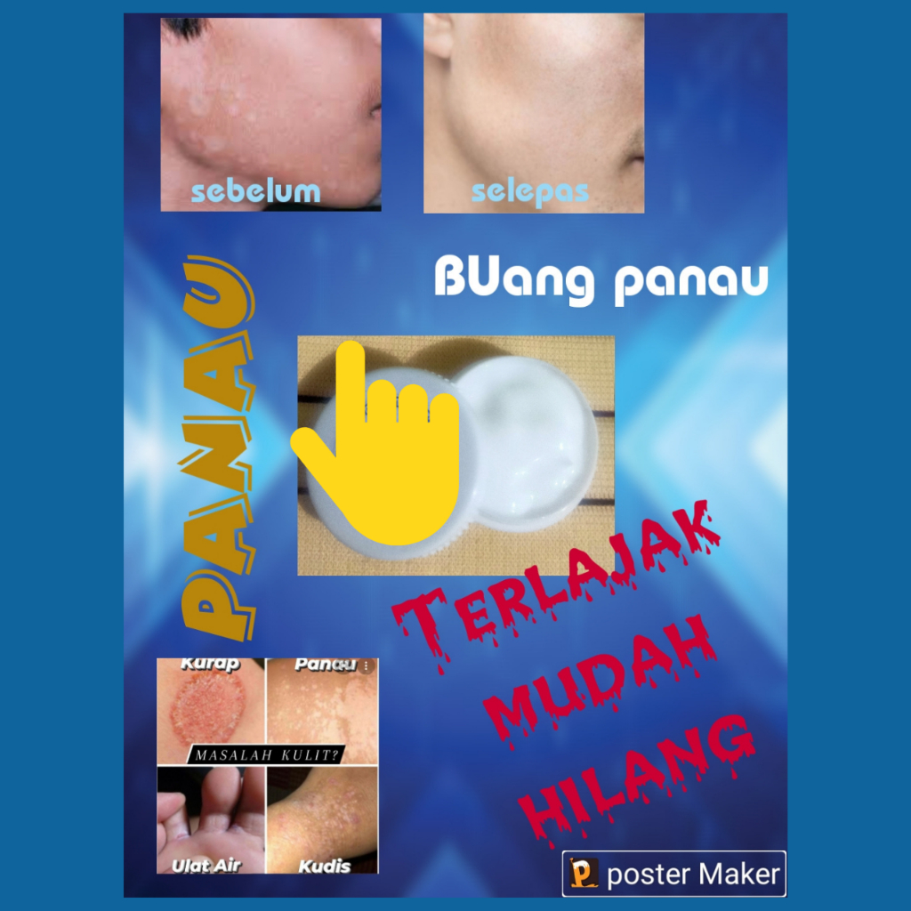 krim panau,hilang panau,hilang kurap,panau lama,panau baru,merawat ...