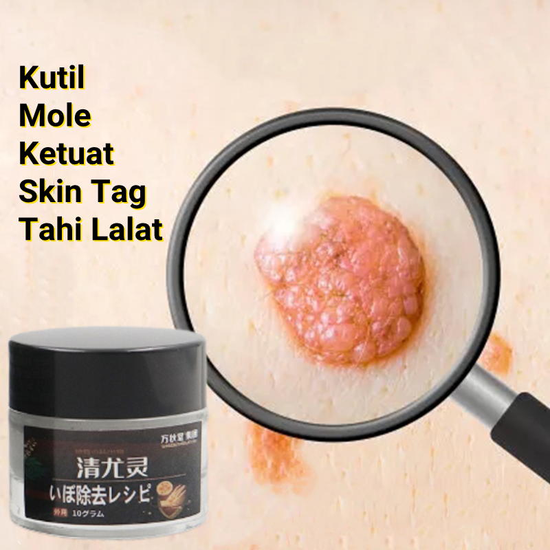 Kutil Kolestrol Di Kelopak Mata Krim Buang Sangat Berkesan Untuk Kutil ...