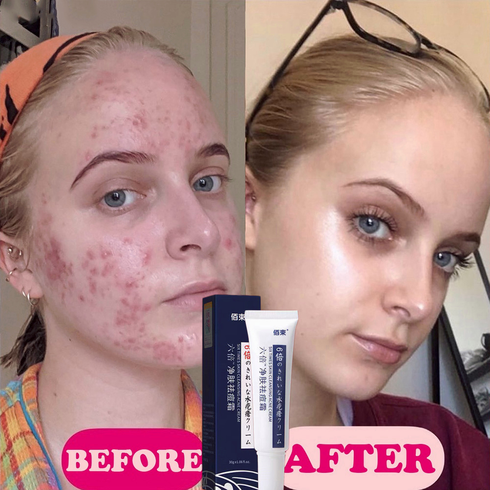 Krim parut Jerawat ubat jerawat muka jerawat acne scar treatment acne ...