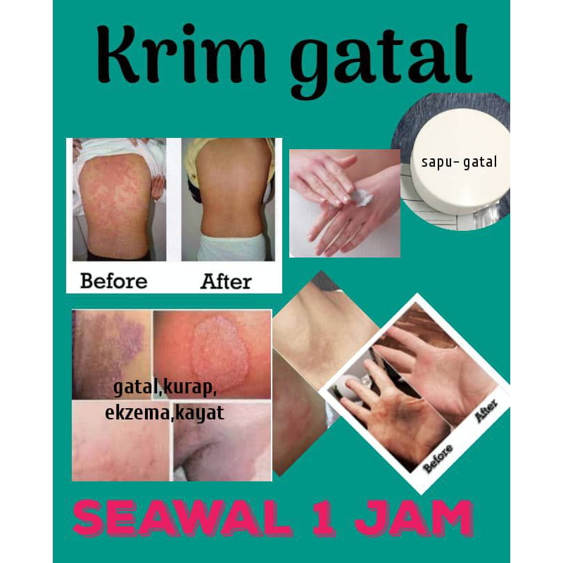 ready stok,hilang gatal berkesan,EKZEMA,KURAP ,PANAU,KUDIS,RUAM-RUAM ...