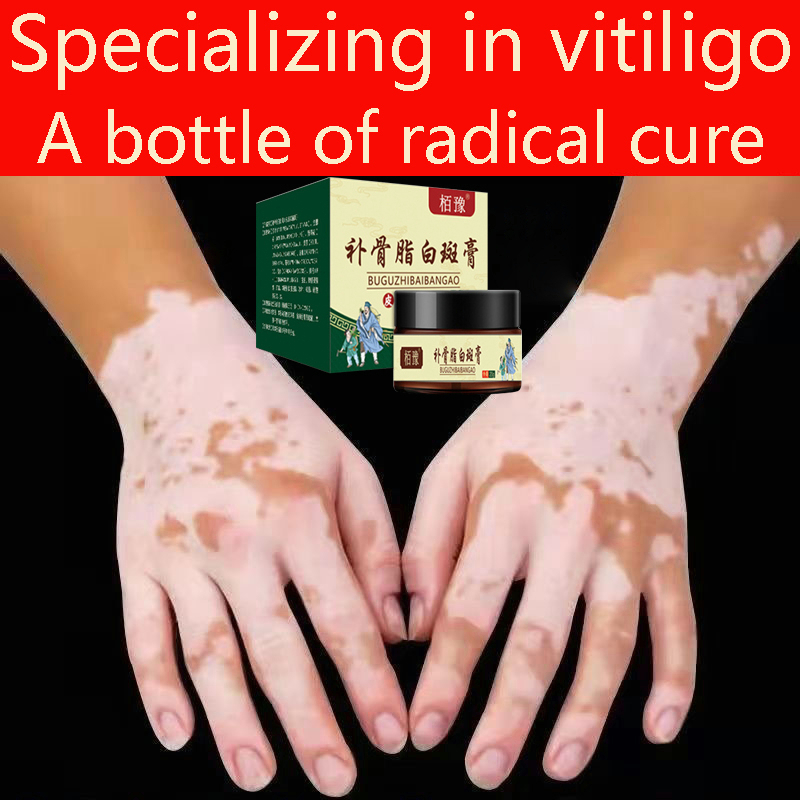 Vitiligo cream Vitiligo treatment cream Penawar Penyakit Sakit Sopak ...