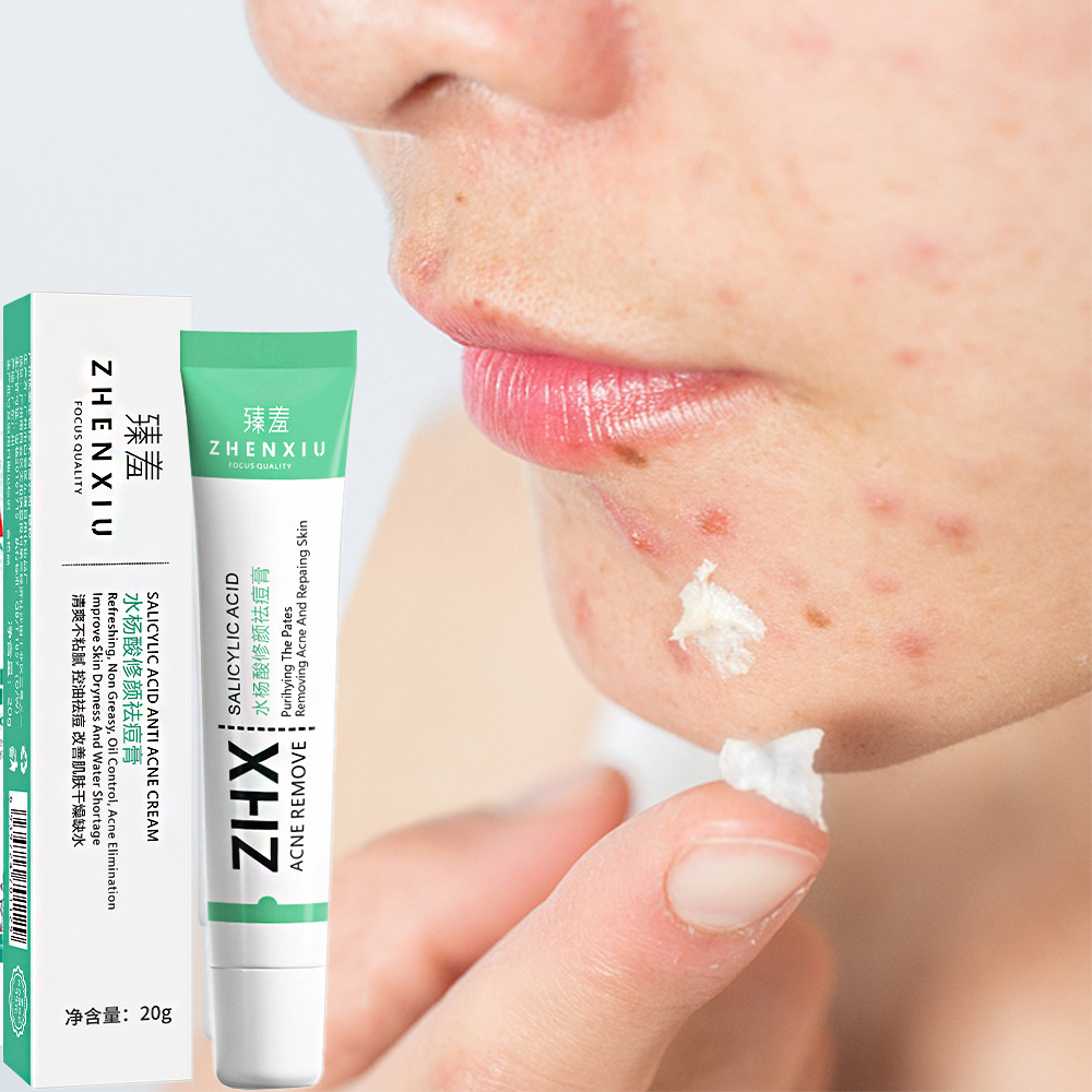 Acne Cream Krim Ubat Jerawat Dan Parut Acne Scar Marks And Acne Pits ...