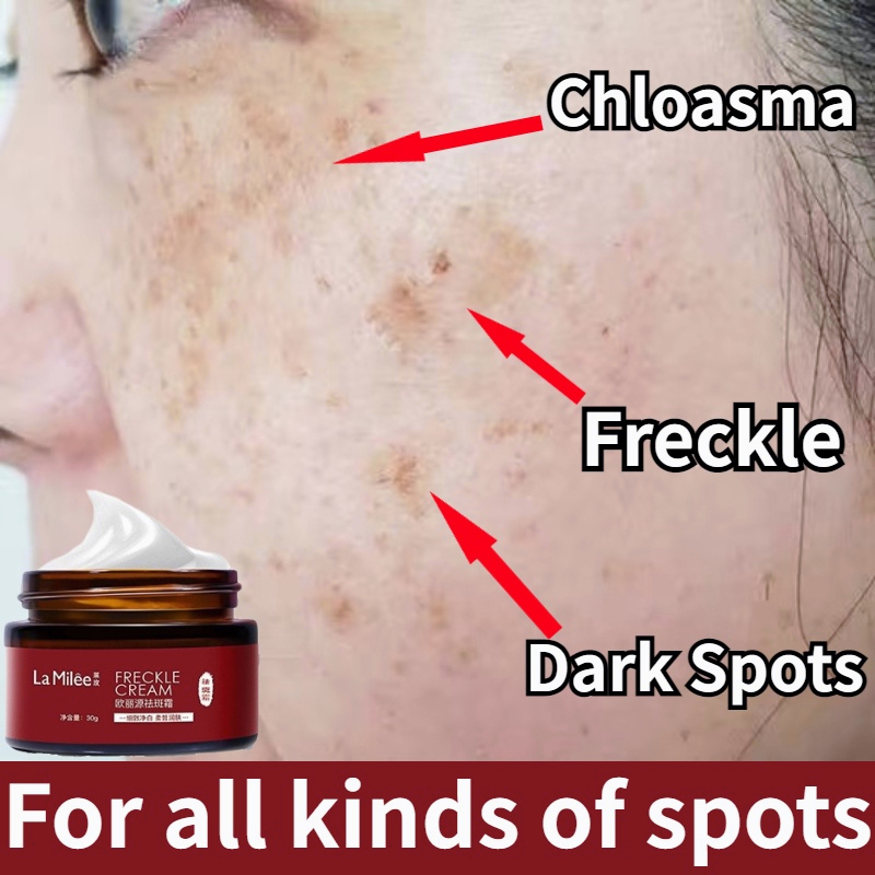 Whitening Freckle Removal Cream Pigmentation Cream Chloasma Spots ...