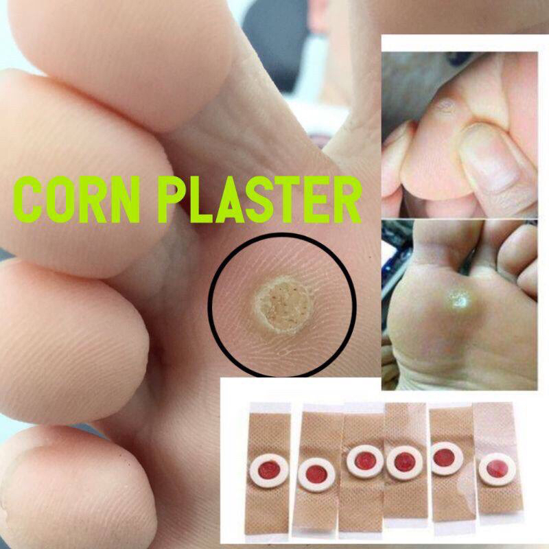CORN PLASTER REMOVER 6Pcs skin tag remover Patch buang ketuat kutil ...