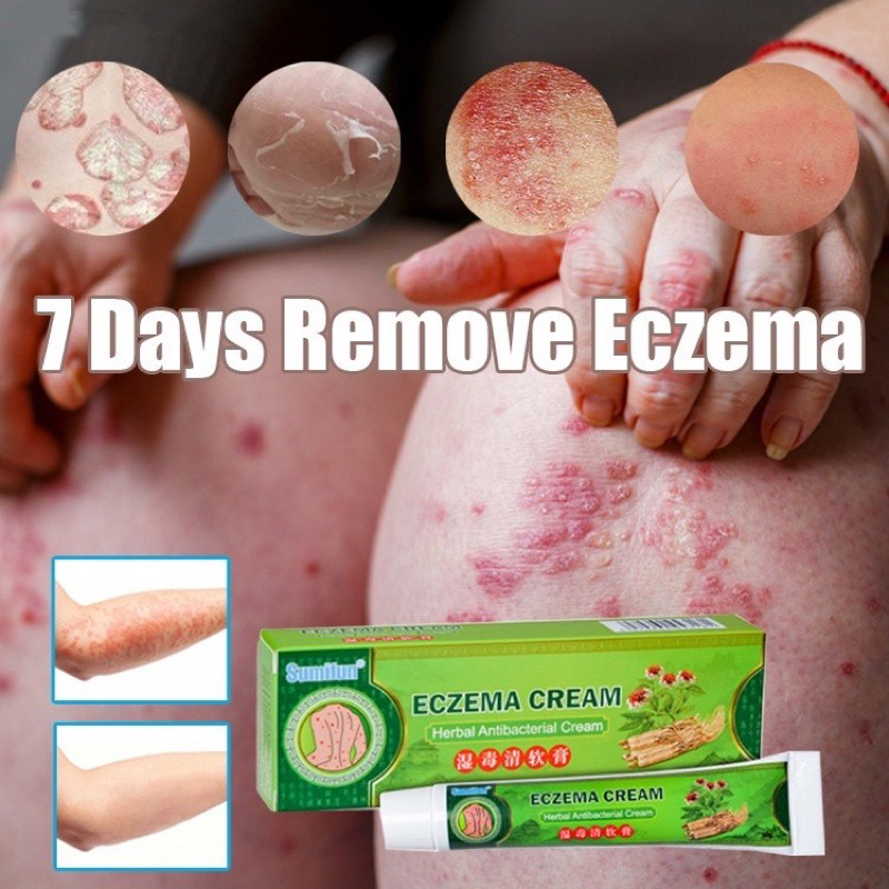 ECZEMA CREAM/CRAEM HERBA KOTAK HIJAU | Shopee Malaysia