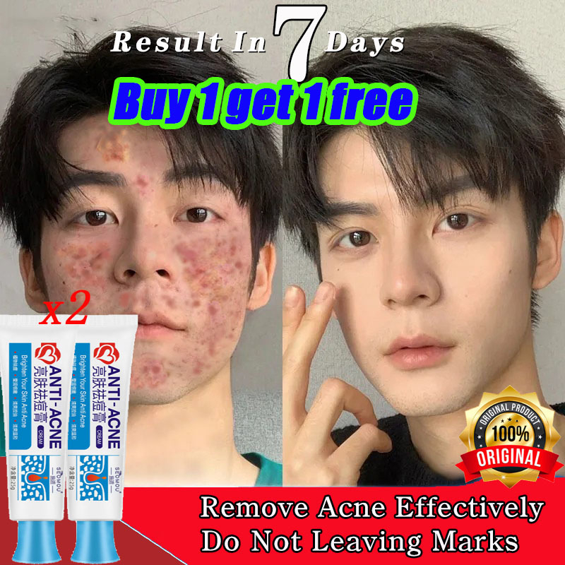 Buy 1 get 1 free Anti-Acne Cream Pimple Scars Remover Cream Acne ...